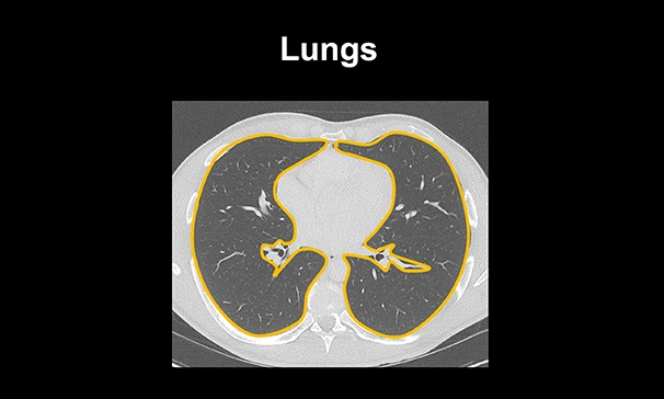 How to identify normal lung anatomy on chest CT | Medmastery